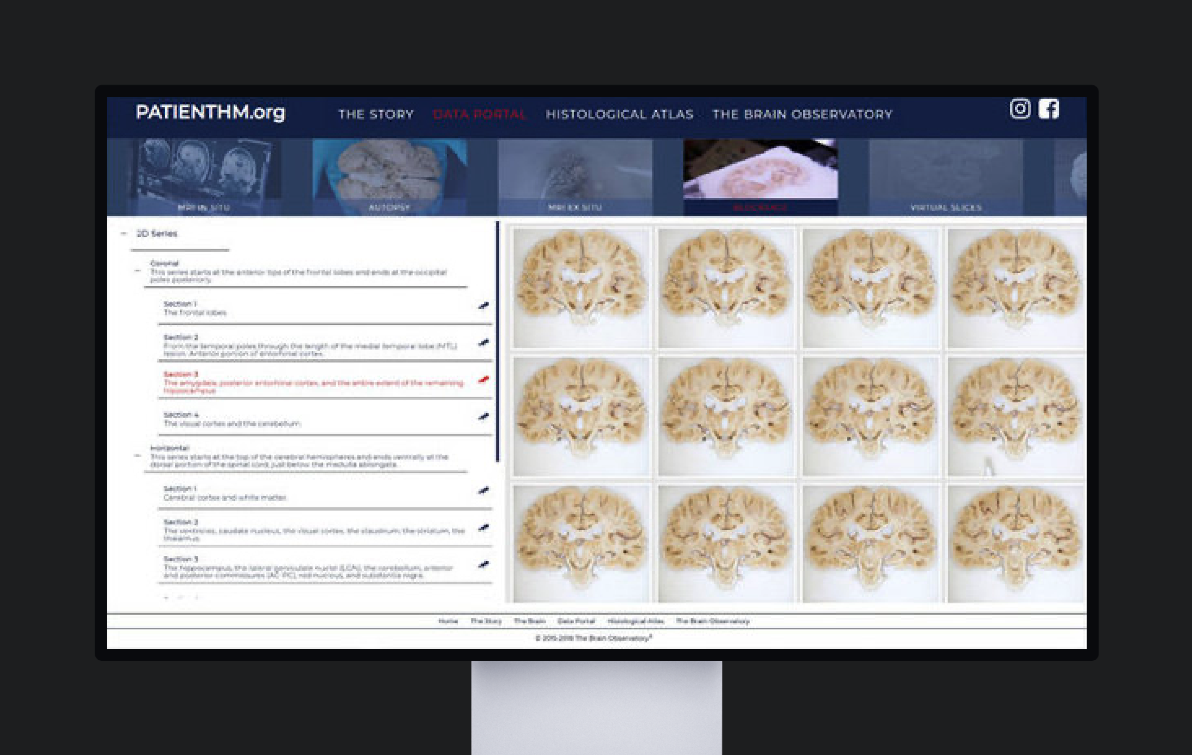 Patient H.M. | Case Study | MetaCell